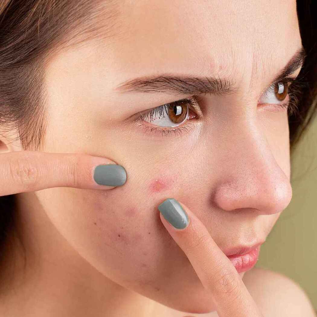Showing Acne Who’s the Boss - Profile MD