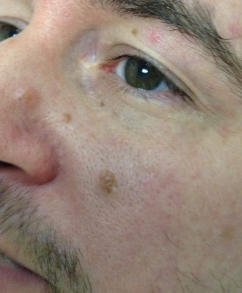 Mole Removal - Profile MD